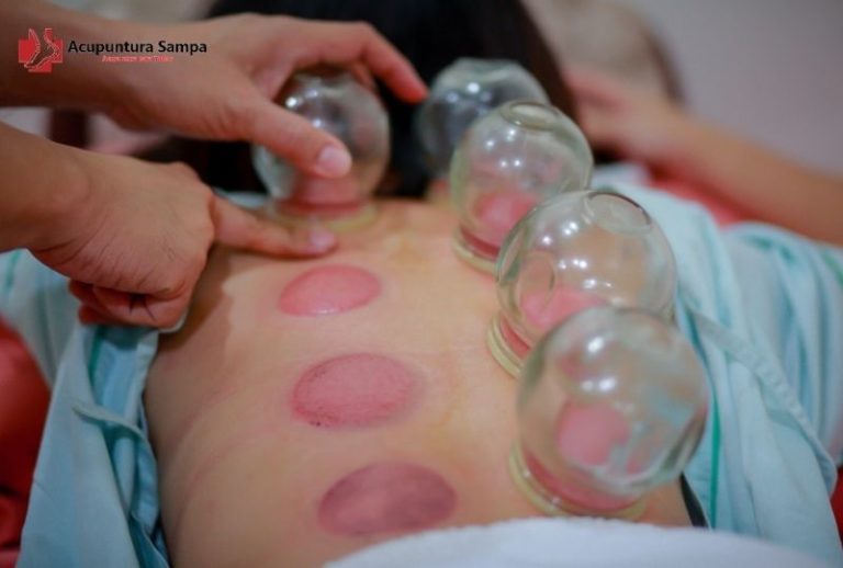 Como funciona a ventosaterapia? Entenda o processo passo a passo